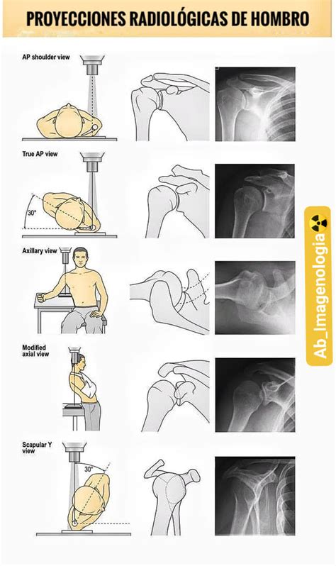 Proyecciones Radiológicas De Hombro Ab Imagenología Facebook
