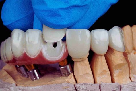 Tooth Decay Under Crown Black Color Joyce The Dentist