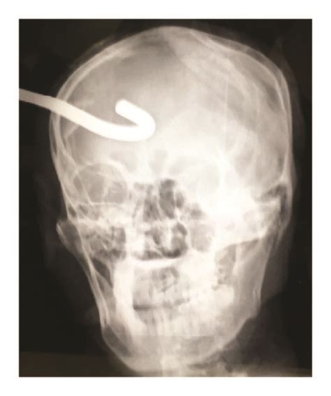 A Plain X Ray Of The Skull A P View Showing A Hook Shaped Metal Bar