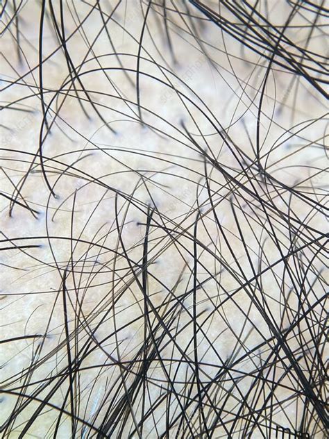 Female Pattern Hair Loss Dermoscopy Stock Image C060 3912 Science Photo Library