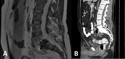 Complicated Retroperitoneal Diverticulitis Presenting With Abscess And