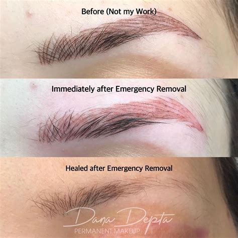 Stages Of Emergency Removal Permanent Makeup Removal Eyebrow Tattoo