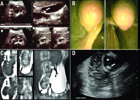 A Abdominal Ultrasound Duodenal Cholecystolithiasis Arrow And A