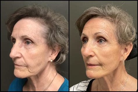 Mini Facelift Before And After Photos Freed Plastic Surgery