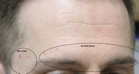 Side Effects Of Rf Micro Needling Vs Erbium Yag Laser Vs Co2 Laser