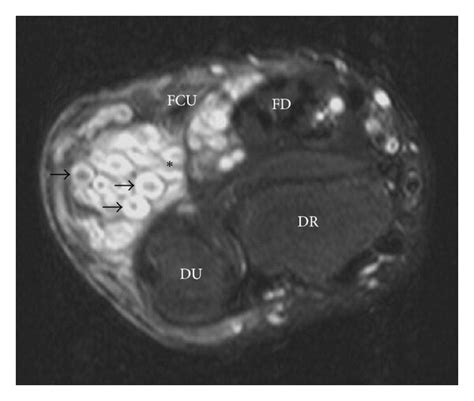Plexiform Neurofibroma Mri Plexiform Neurofibroma Of The Uterus