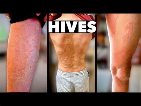What To Do With Allergic Reaction Rash From Honey