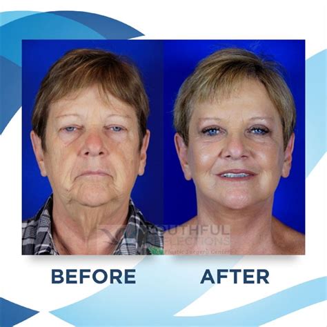 Cheek Implants Before And After Cheek Implants Laser Skin Resurfacing