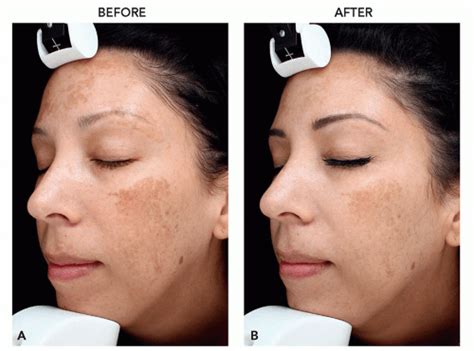 Melasma Plastic Surgery Key