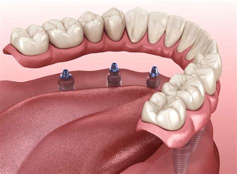 Single Tooth Denture Atlas Dental Toronto