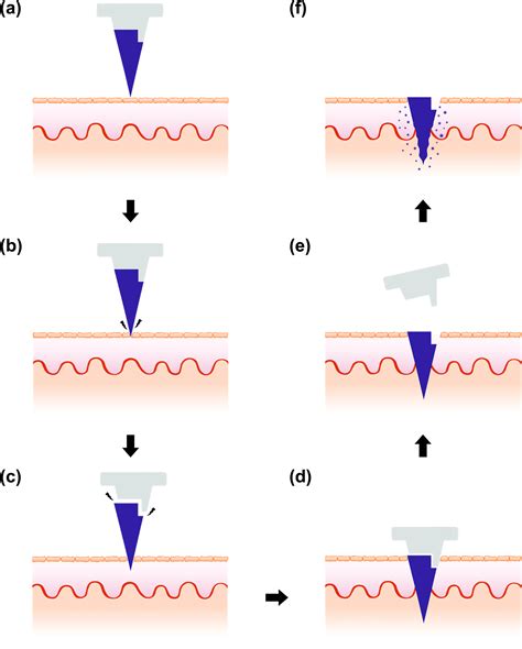 Immediate Separation Of Microneedle Tips From Base Array During Skin