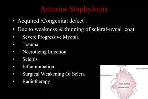 Staphyloma Ppt