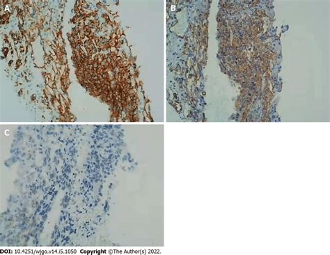 Immunohistochemical Staining The Hepatic Angiosarcoma Components Are