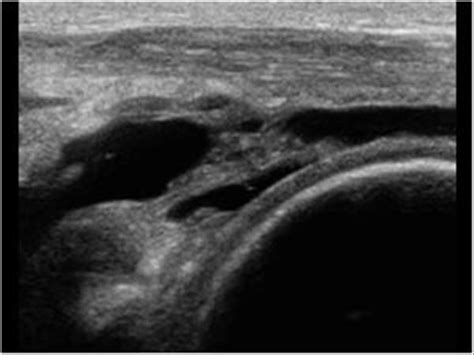 Musculoskeletal Joints And Tendons 6 1 Shoulder Case 6 1 13 Rotator Cuff Subscapularis