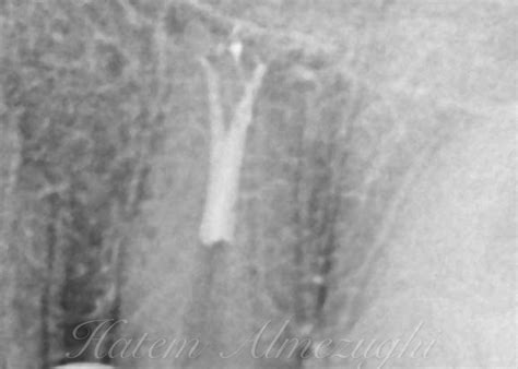 Management Of Deep Apical Split Style Italiano Endodontics