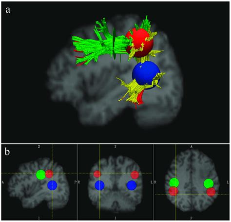 The Reconstruction Of The Bilateral Arcuate Fasciculus Af A A Download Scientific Diagram