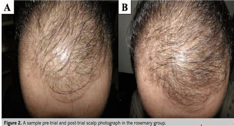 Can Rosemary Oil Regrow Hair The Proof Supplement Clarity