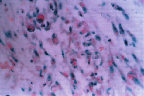 Fat Droplets In The Cytoplasm Of Liposarcoma Cells Sudan Download