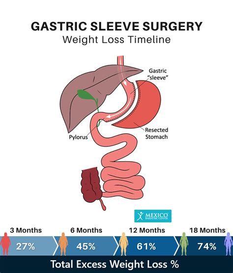 Bariatric Surgery Weight Loss Calculator
