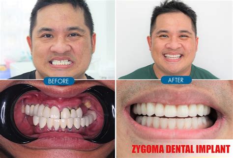 Zygoma Implants For Upper Jaw Advantages Benefits Procedure Cost