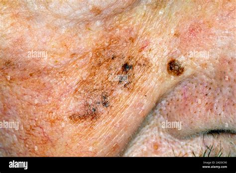 Lentigo Maligna Close Up Of Lentigo Maligna On The Cheek Of A 92 Year