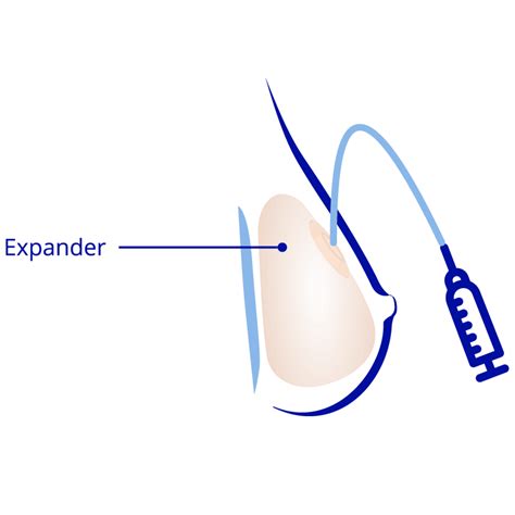 Expanders Global Bibm