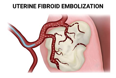 Womens Health And Ir Uterine Fibroid Embolization And Minimally