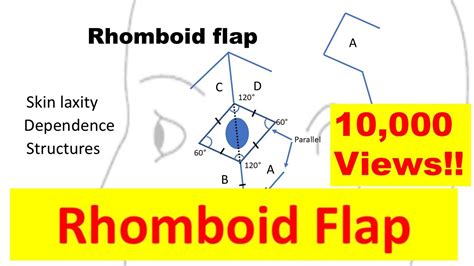 Rhomboid Flap