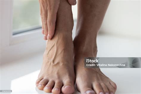 Woman Touching Her Feet With Large Swollen Veins Varicose Veins Concept