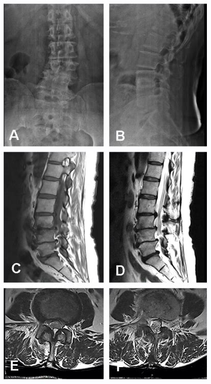 Osteophyte Formation Lumbar Spine