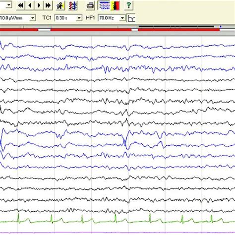 Electroencephalography Of Patient With Hot Water Epilepsy With Download Scientific Diagram