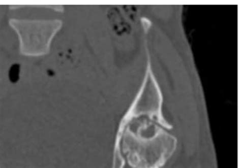 Understanding Ionization Chambers And Their Uses