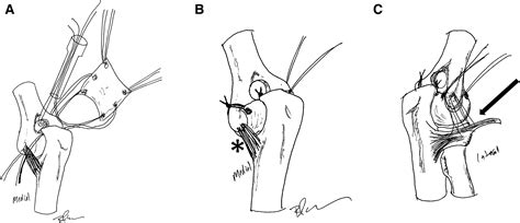 Arthroscopically Assisted Elbow Interposition Arthroplasty Without