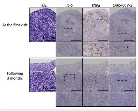Expression Patterns Of Interleukin 6 Il 6 And Tumor Necrosis Factor α