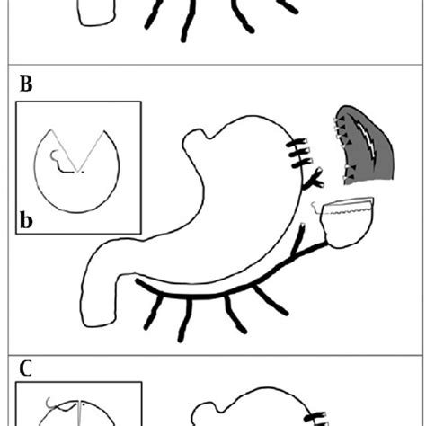 Schematic Representation Of Partial Splenectomy Download Scientific