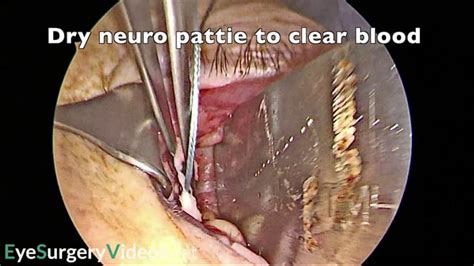 Punctoplasty Punctal 3 Snip Procedure Oculoplastic