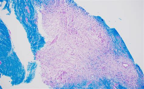Pathology Outlines Multiple Sclerosis