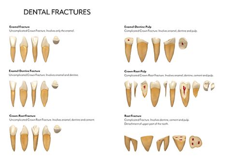 Pakistan Association Of Legal Dentistry A Classification Of Dental Fractures Commonly Seen