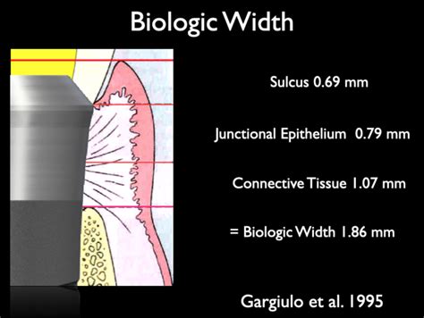 Biological Width Around Implant
