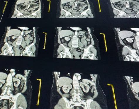 Ct Abdomen General