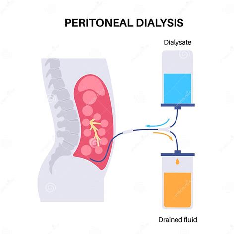 Peritoneal Dialysis Concept Stock Vector Illustration Of Drain