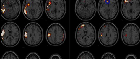 Robotised And Neuronavigated Transcranial Magnetic Stimulation With Concurrent