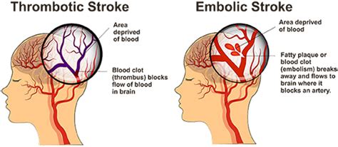 Brain Stroke Cell Therapy