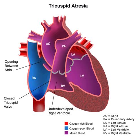 Tricuspid Atresia Ta