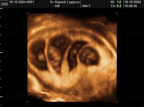 Pregnant With Quintuplets Ultrasound