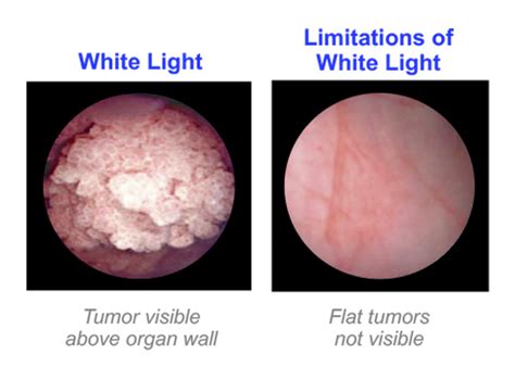 Bladder Cancer Blue Light Cystoscopy Imagin Medical