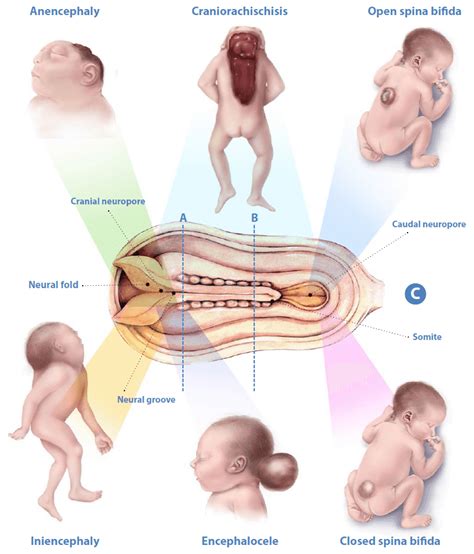 Congenital Anomaliesbirth Defects