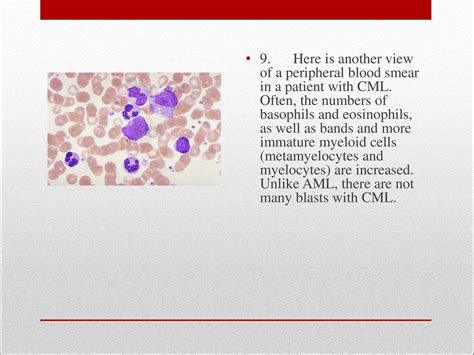 Leukemias Tamara Datsko Associate Professor Of Pathology Ppt Download