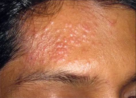 Papular Rash Causes Varieties Health