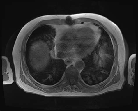 Cholangiocarcinoma Hilar Type Radiopaedia 59780 67206 Axial T1 In